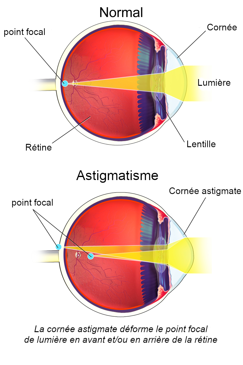 Astigmatism/fr - Endmyopia Wiki